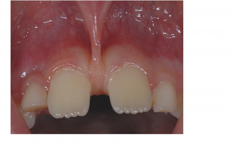 Interprete Producción Persona australiana frenulo labial Velocidad ...